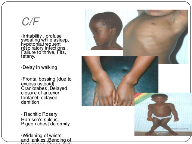 Rickets & Osteomalacia