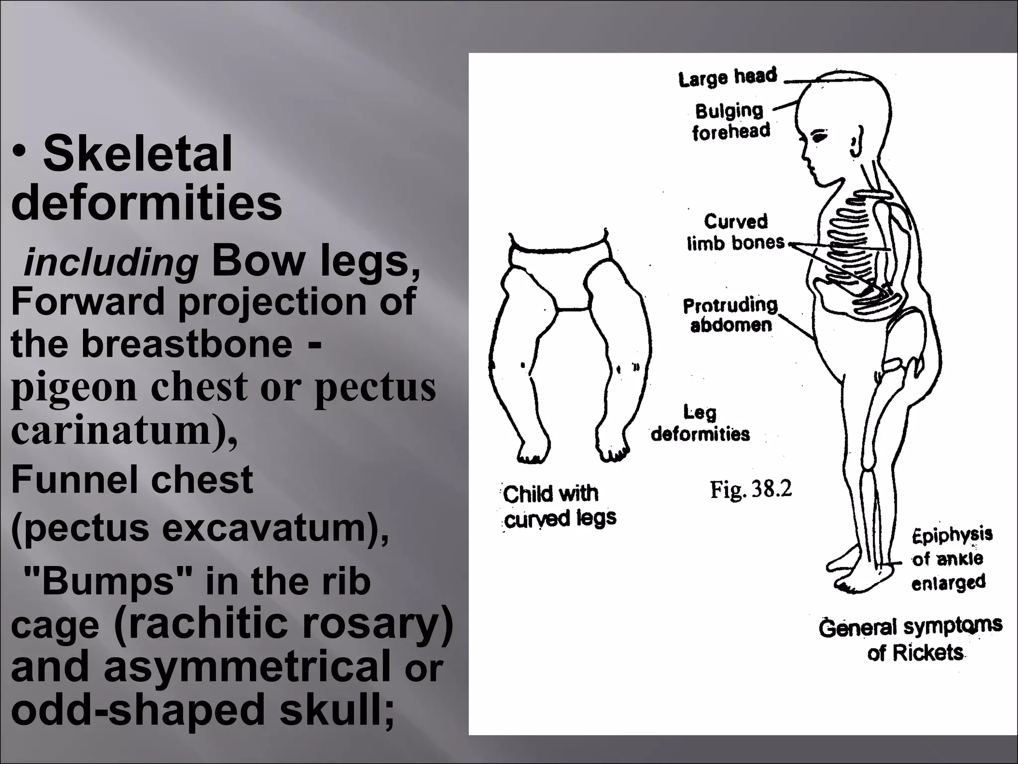 Rickets | PPT