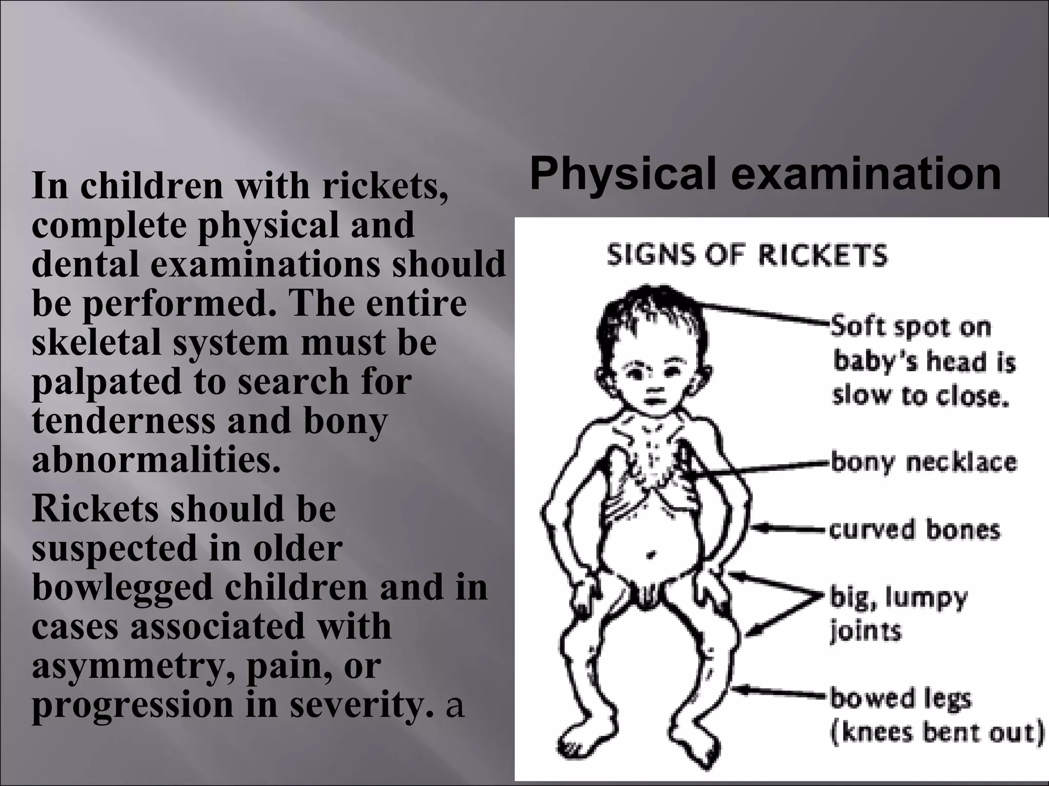 Rickets | PPT