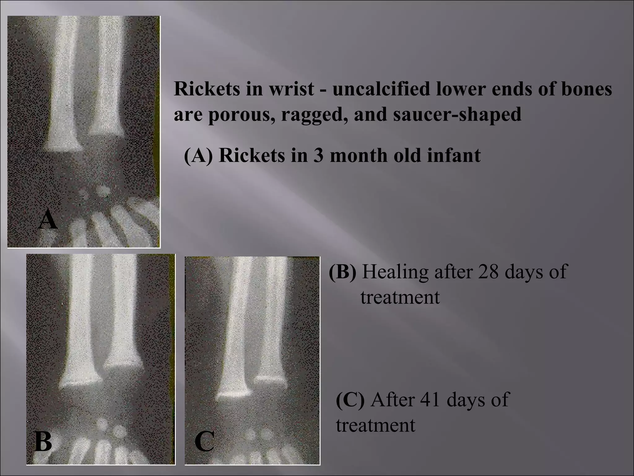 Rickets | PPT