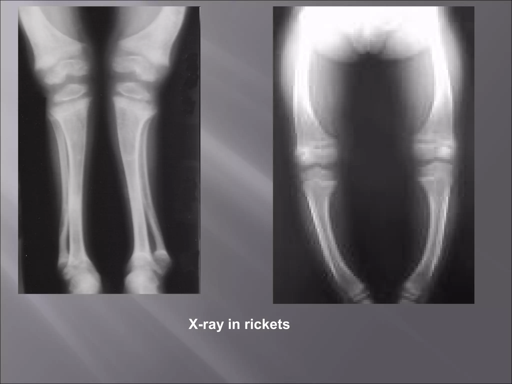 Rickets | PPT