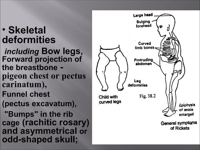 Rickets | PPT