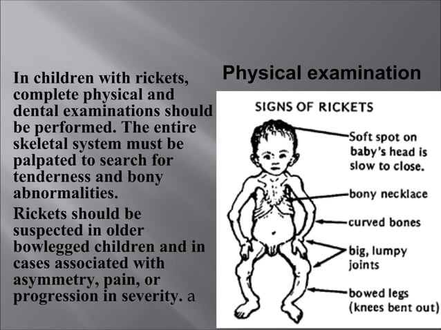 Rickets | PPT