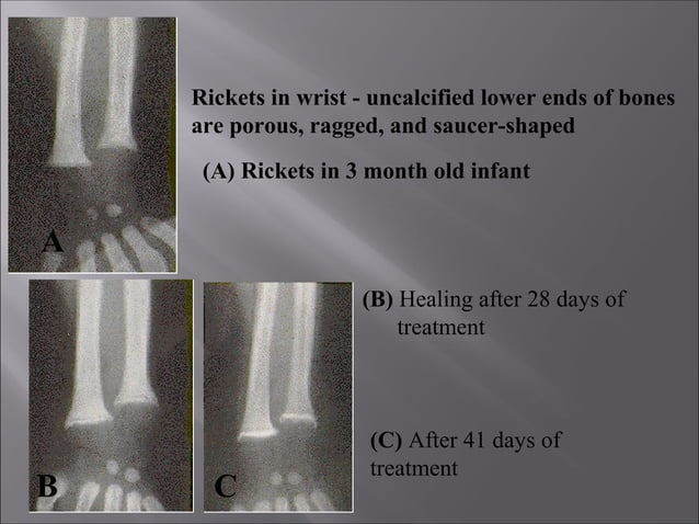 Rickets | PPT