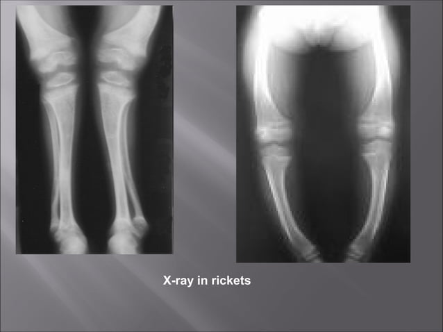 Rickets | PPT