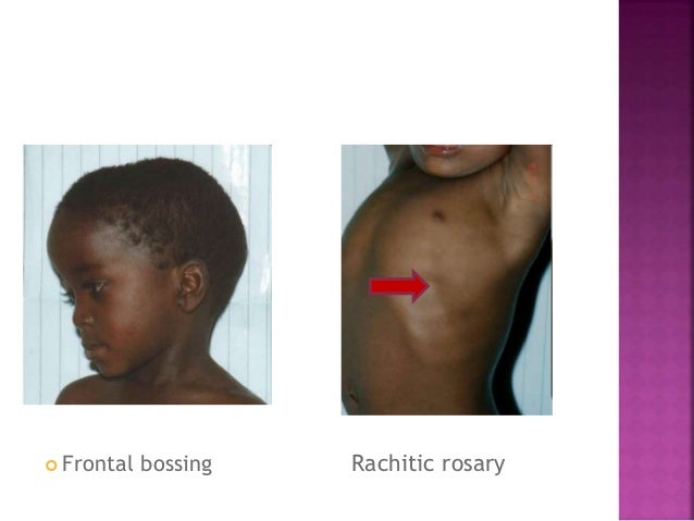 Rickets a brief outlook