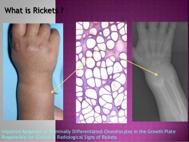 Rickets a brief outlook