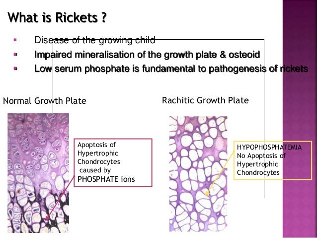 Rickets a brief outlook