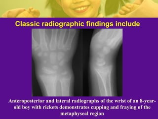 Rickets | PPT