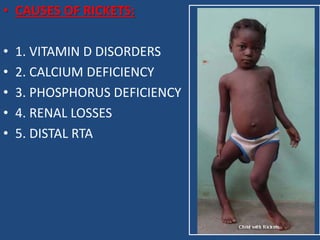 Rickets.. Dr.Padmesh | PPT