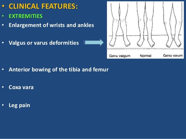 Rickets.. Dr.Padmesh
