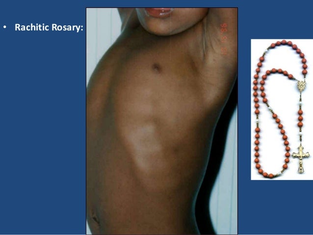 Rickets.. Dr.Padmesh