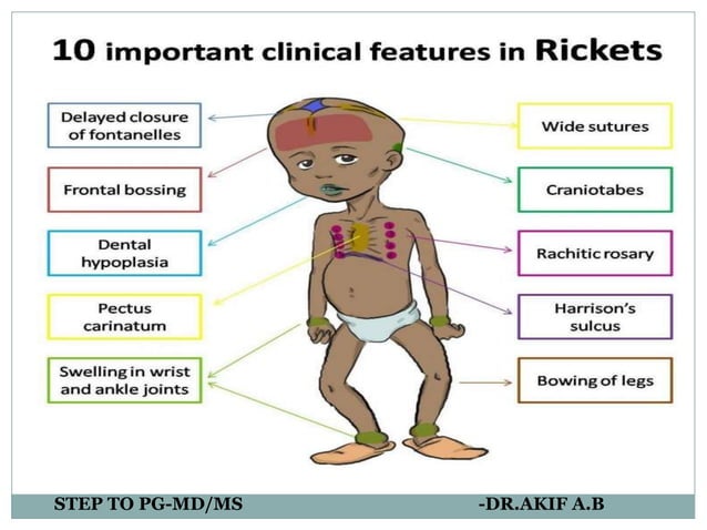 Rickets | PPT