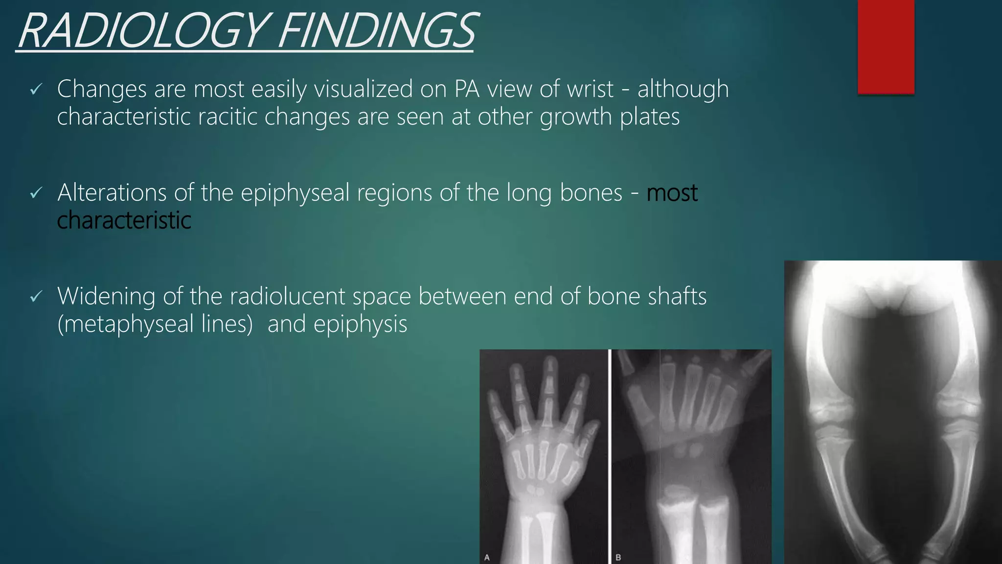 Rickets | PPTX | Bone and Joint Conditions | Diseases and Conditions