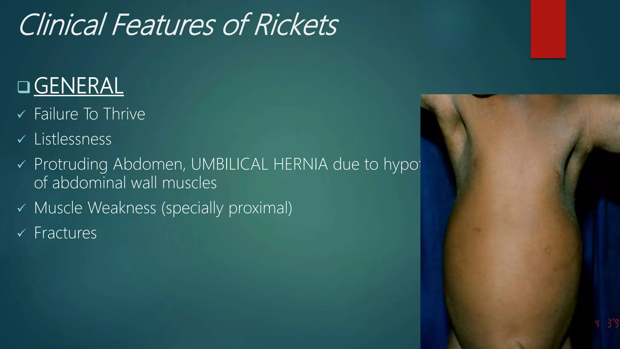 Rickets | PPTX | Bone and Joint Conditions | Diseases and Conditions