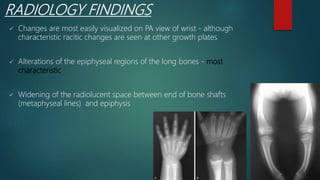 Rickets | PPTX | Bone and Joint Conditions | Diseases and Conditions
