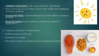 Rickets | PPTX | Bone and Joint Conditions | Diseases and Conditions