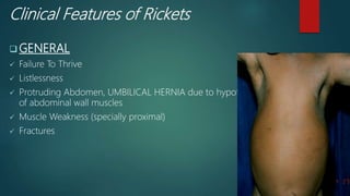 Rickets | PPTX | Bone and Joint Conditions | Diseases and Conditions