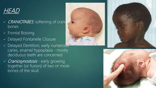 Rickets | PPTX | Bone and Joint Conditions | Diseases and Conditions