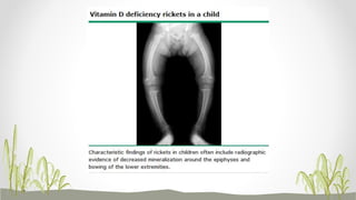 Rickets | PPT