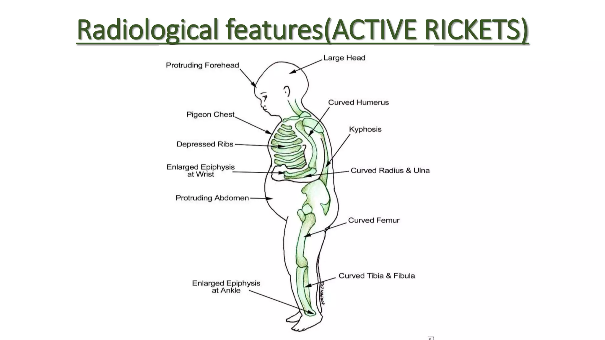 Rickets | PPTX