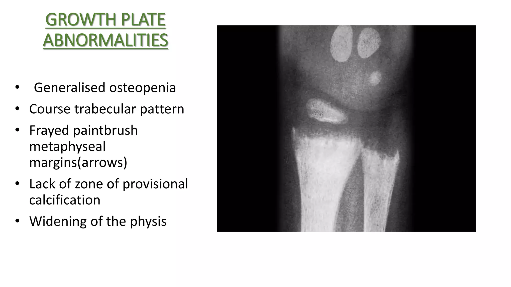 Rickets | PPTX | Bone and Joint Conditions | Diseases and Conditions