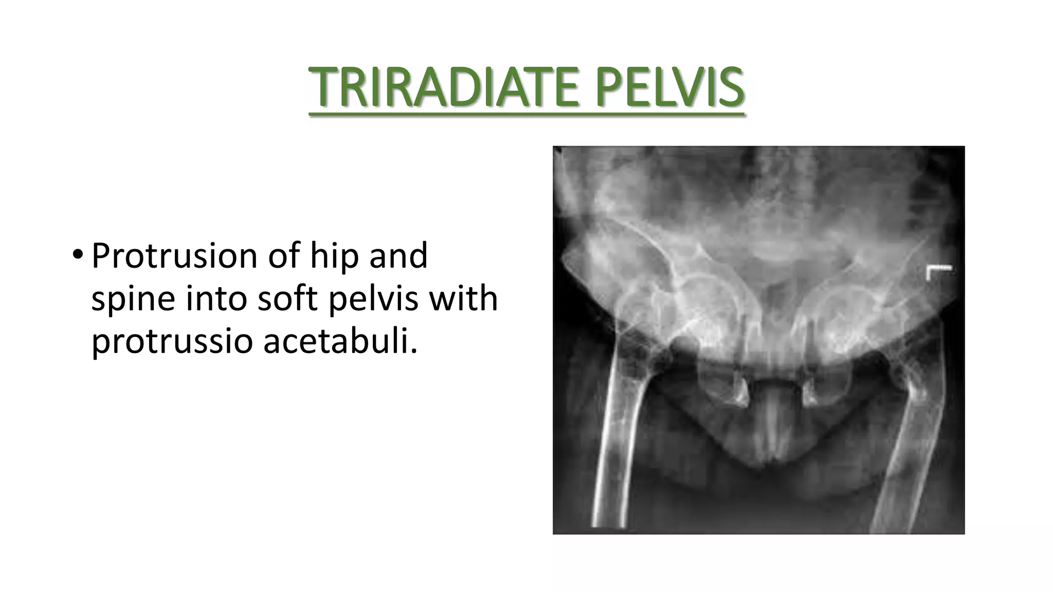 Rickets | PPTX | Bone and Joint Conditions | Diseases and Conditions