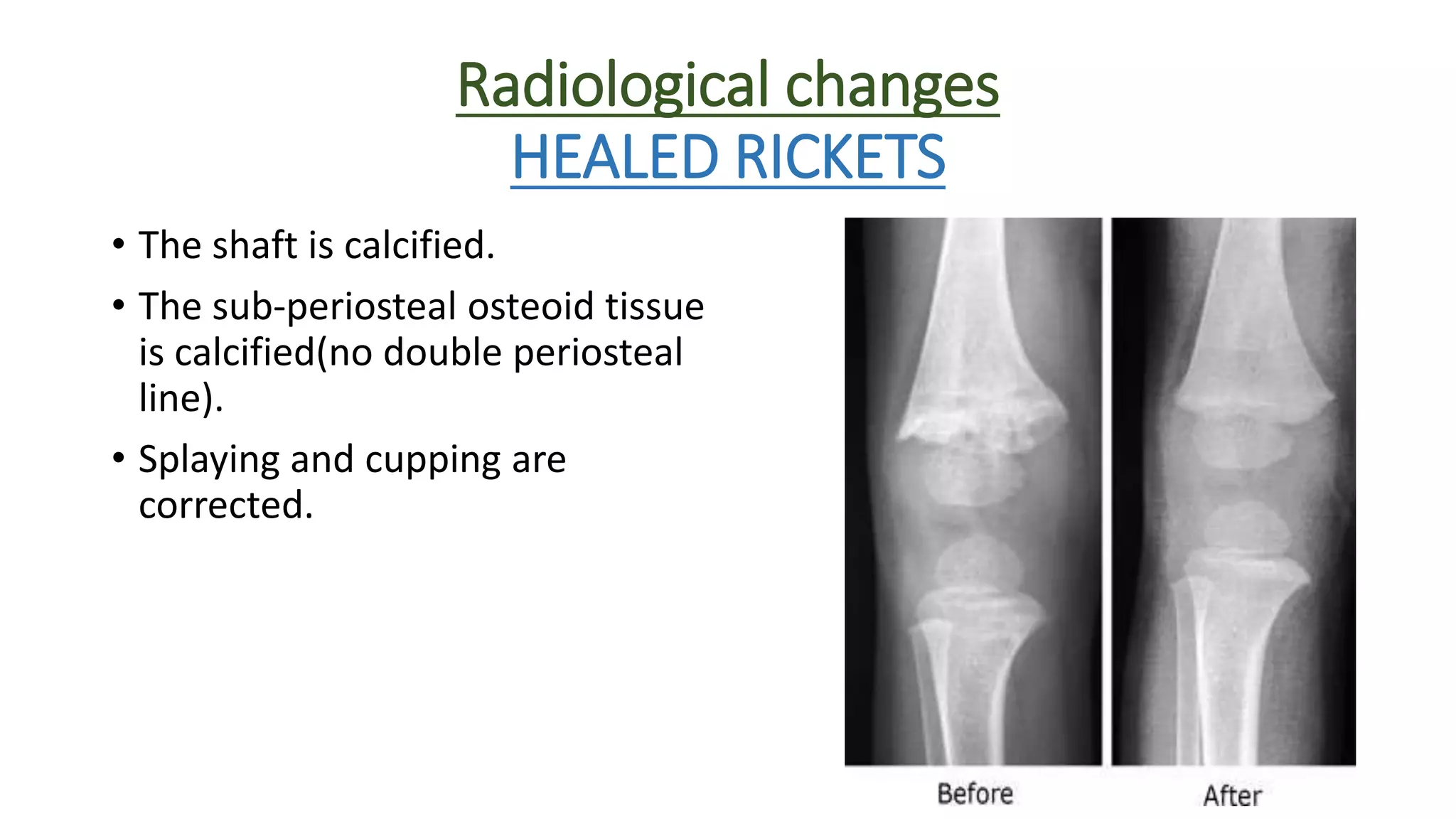 Rickets | PPTX