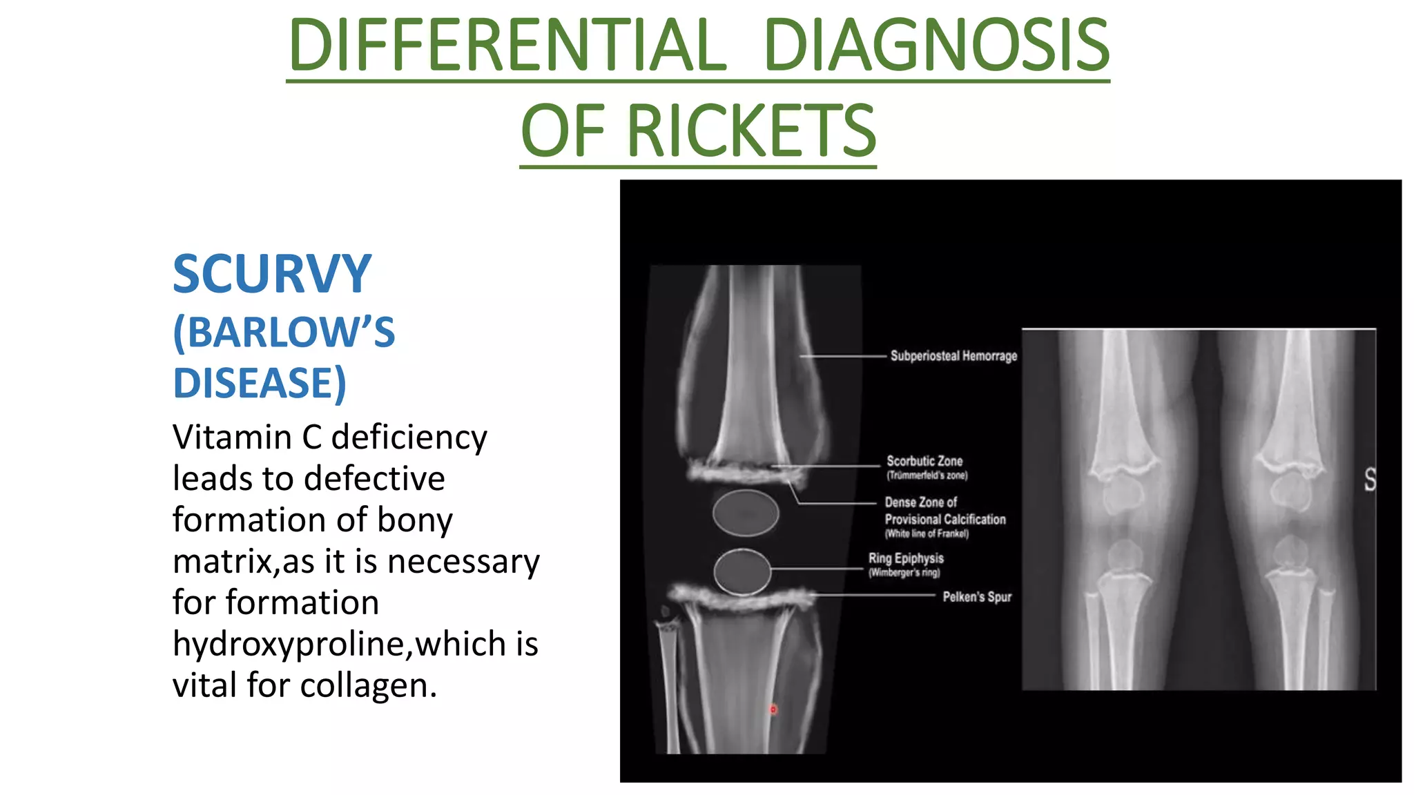 Rickets | PPTX | Bone and Joint Conditions | Diseases and Conditions