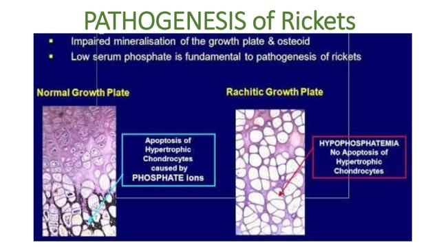 Rickets | PPTX | Bone and Joint Conditions | Diseases and Conditions