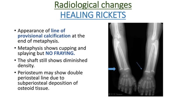 Rickets | PPTX | Bone and Joint Conditions | Diseases and Conditions