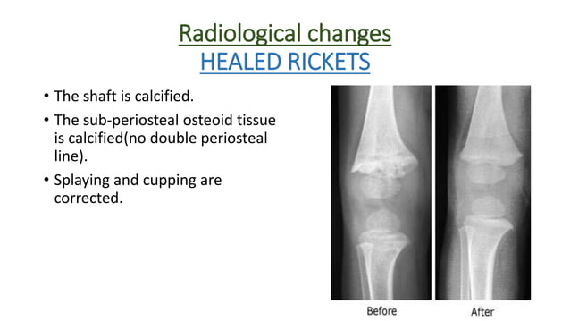 Rickets | PPTX | Bone and Joint Conditions | Diseases and Conditions