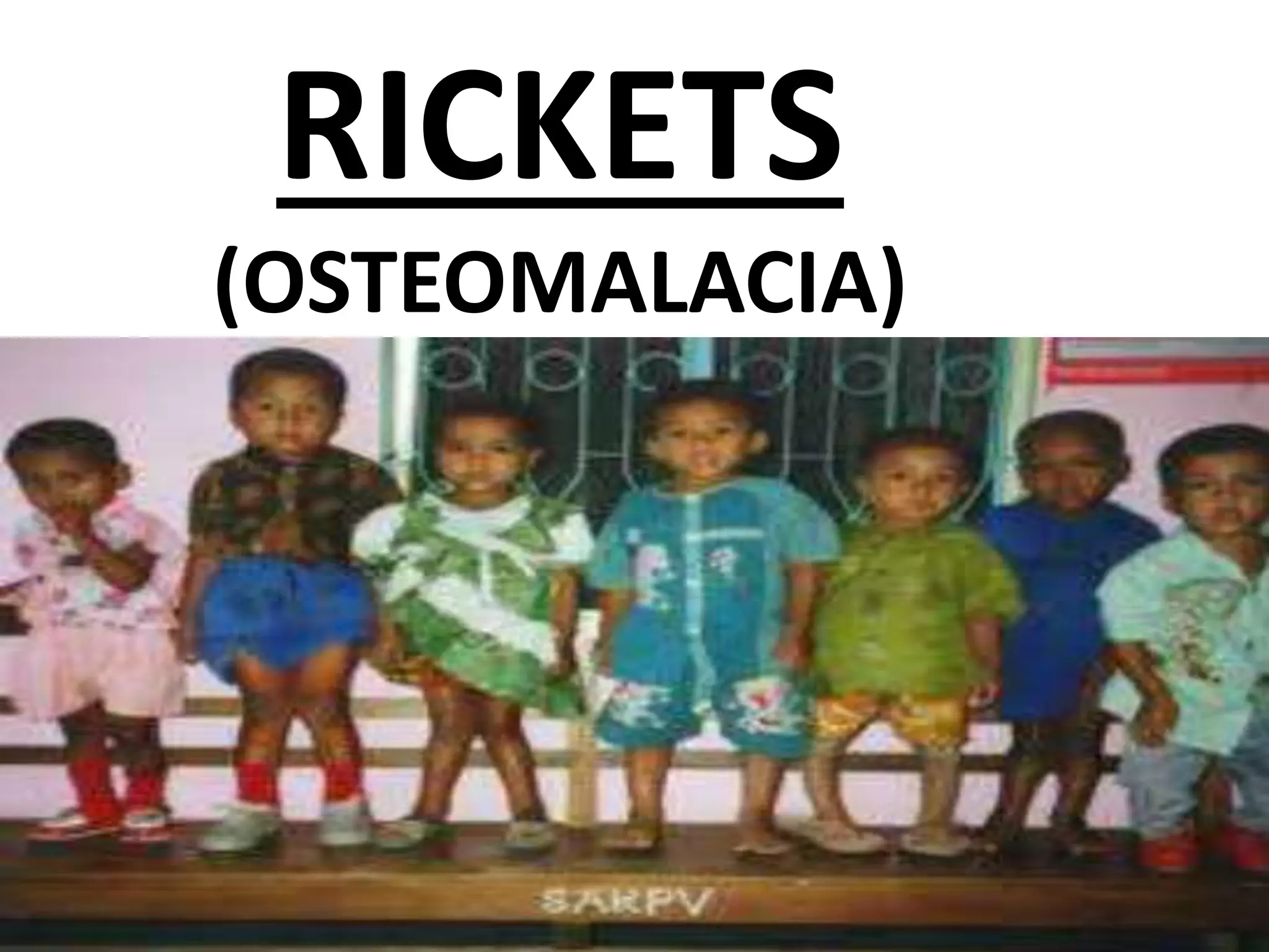 Rickets | PPT