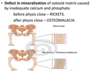 Rickets | PPT