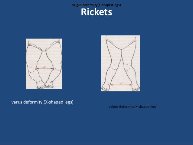 Rickets