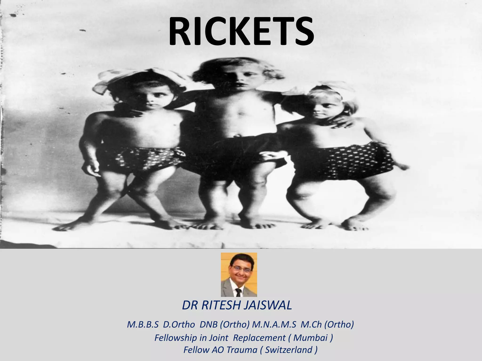 RICKETS | PPTX