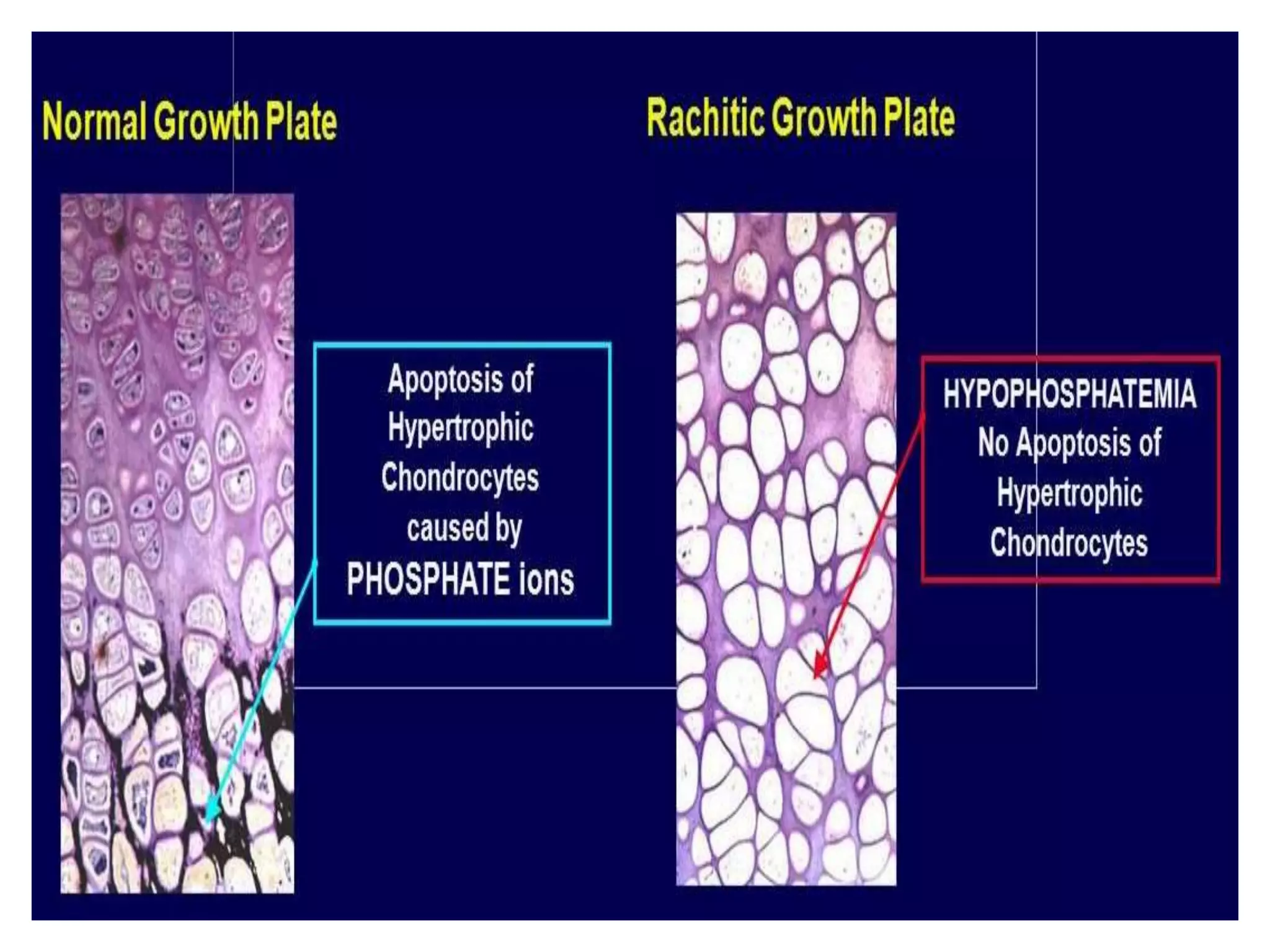 RICKETS | PPTX