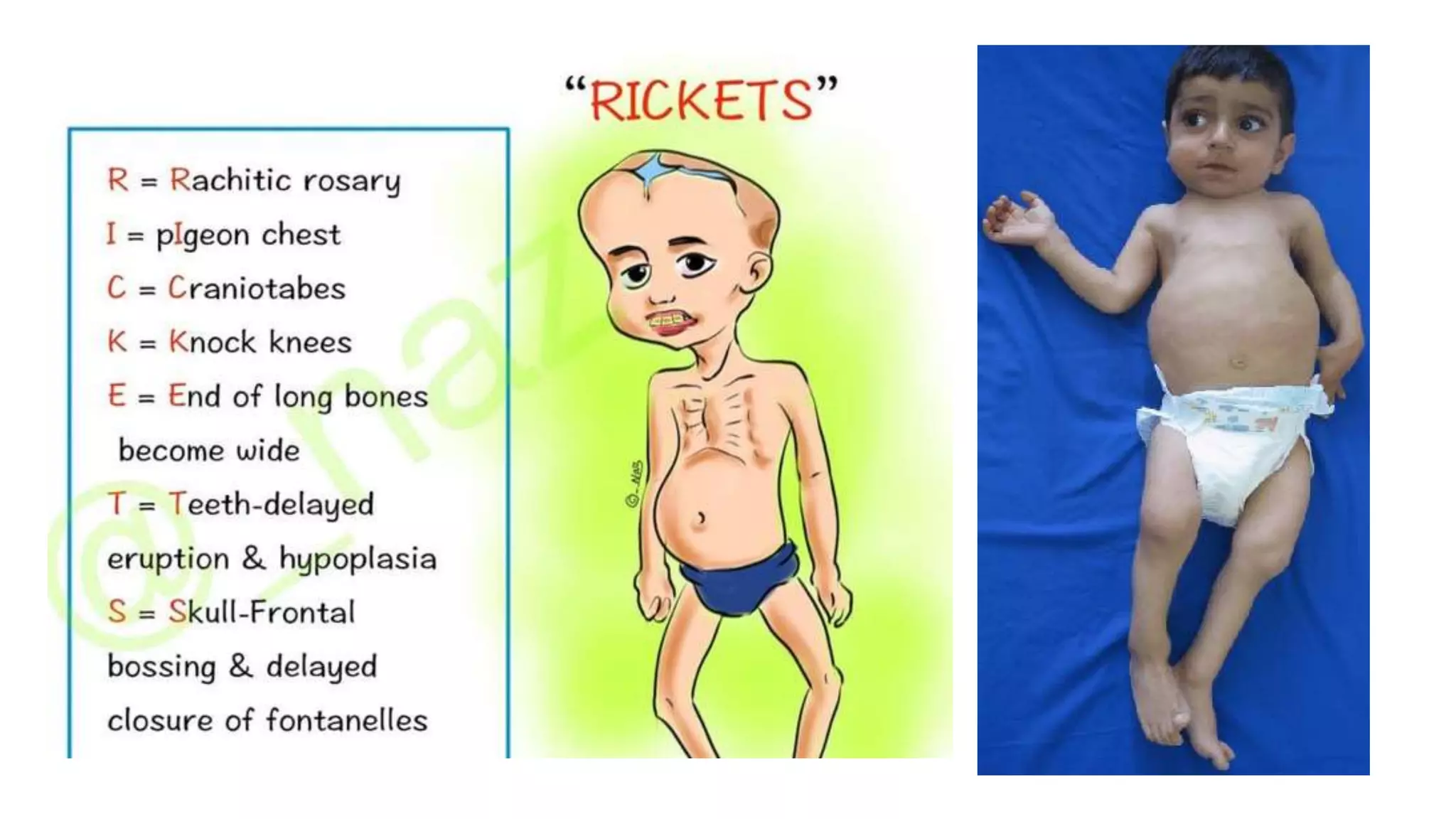 Rickets | PPTX