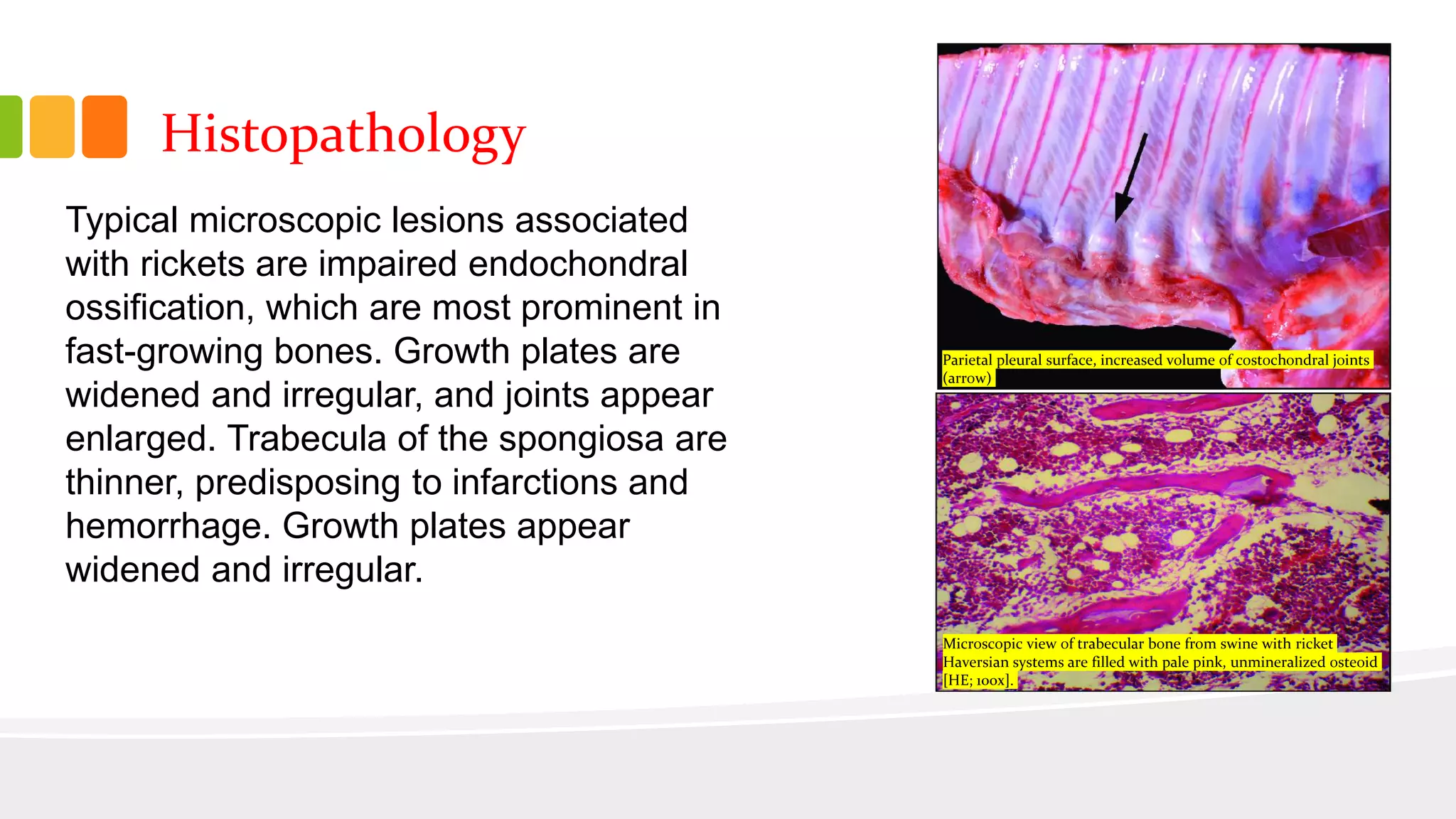 Rickets/ Oestomalacia Pathology | PPTX