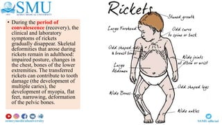 Rickets.pptx