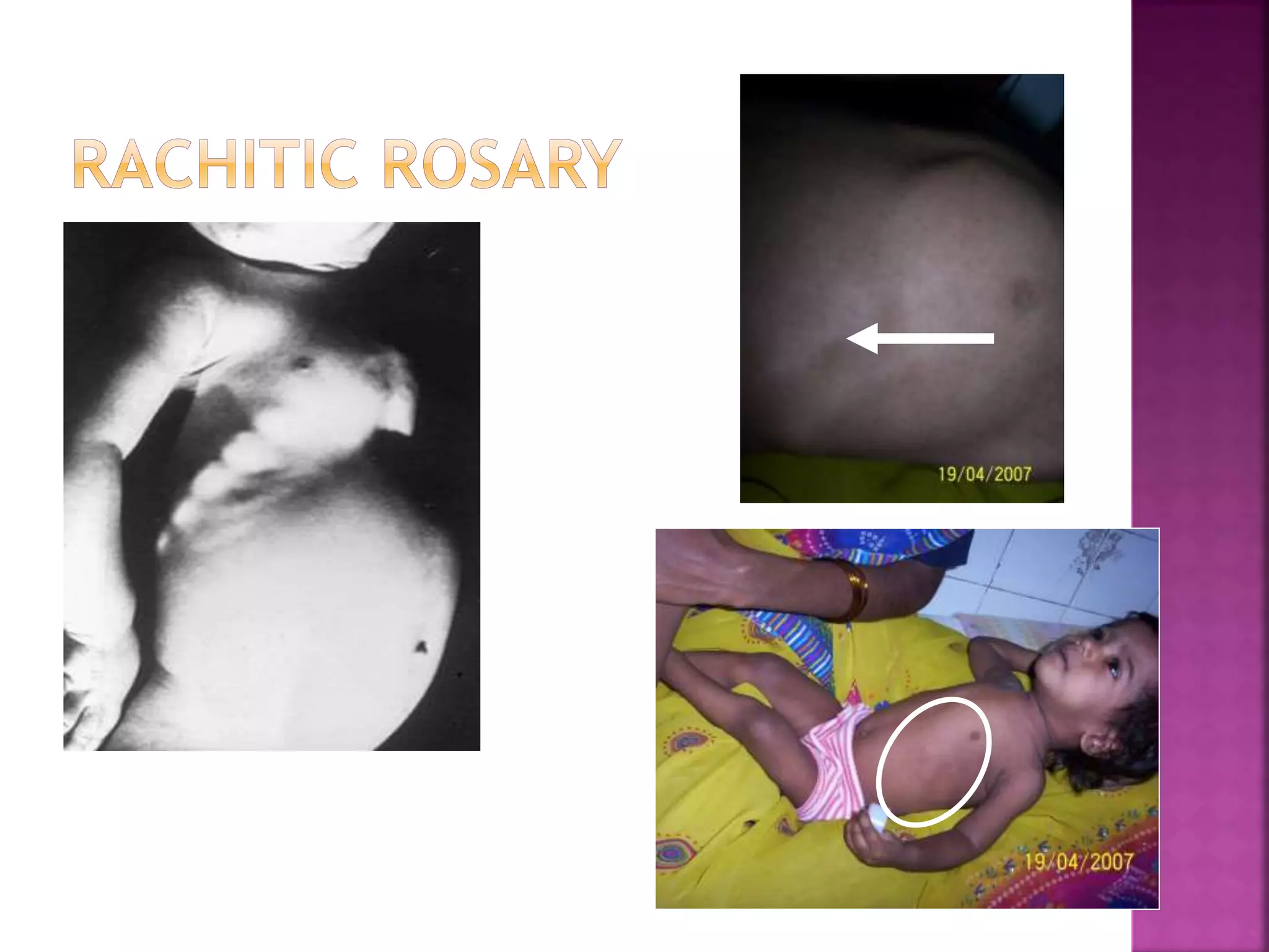 RICKETS clinical features | PPTX