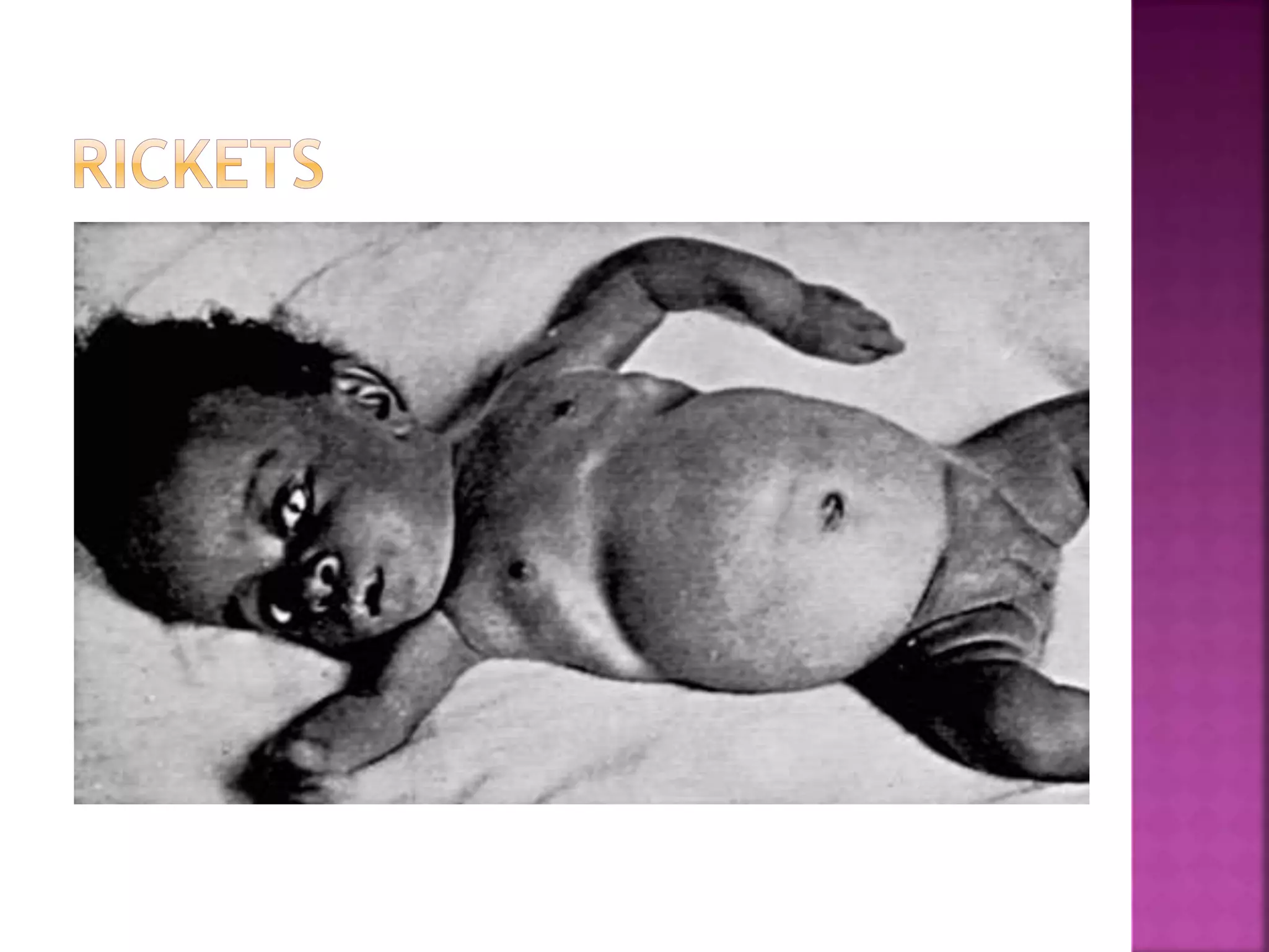 RICKETS clinical features | PPTX