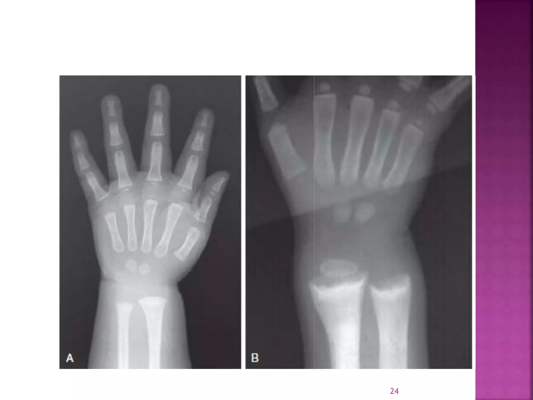 RICKETS clinical features | PPTX