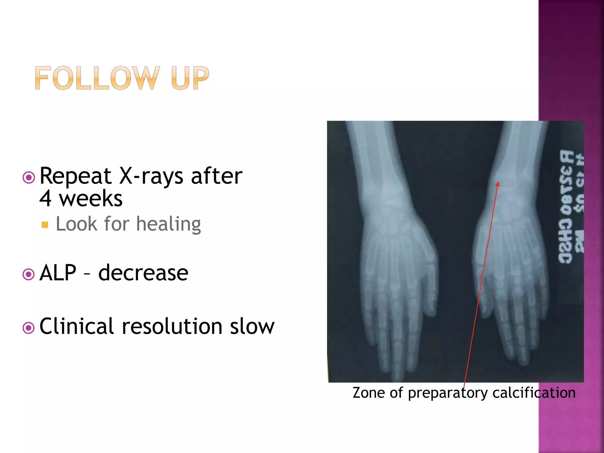 RICKETS clinical features | PPTX