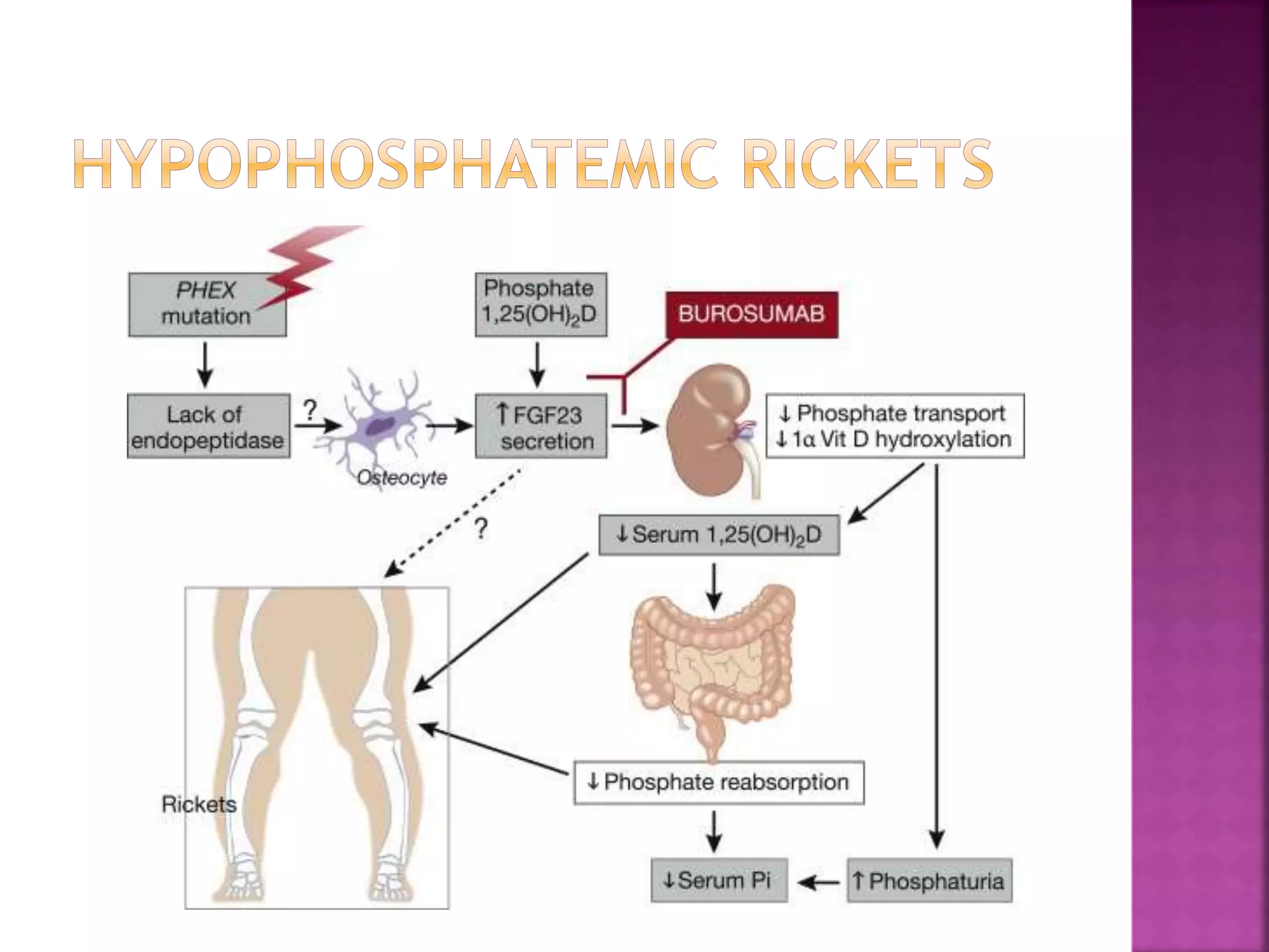 RICKETS clinical features | PPTX