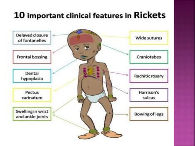RICKETS clinical features | PPTX