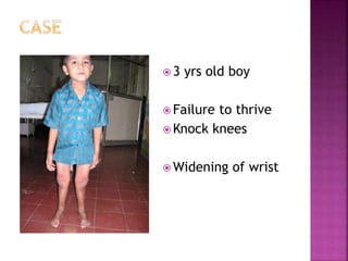 RICKETS clinical features | PPTX