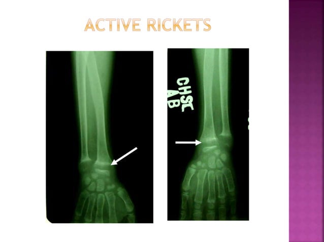 RICKETS clinical features | PPTX