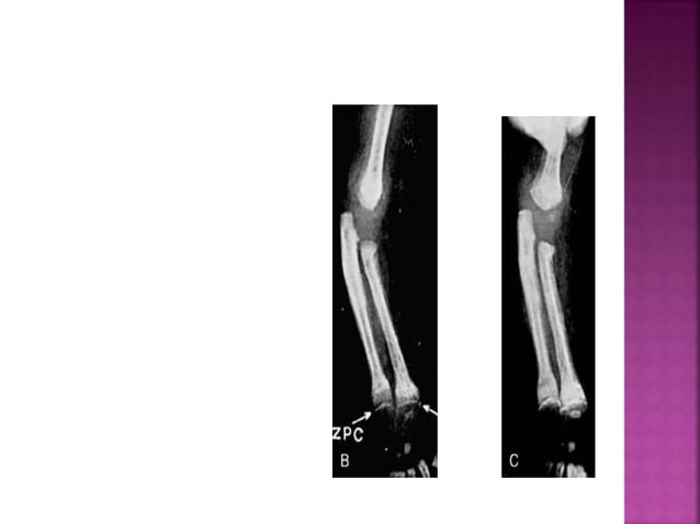RICKETS clinical features | PPTX