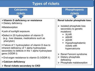rickets | PPT | Free Download